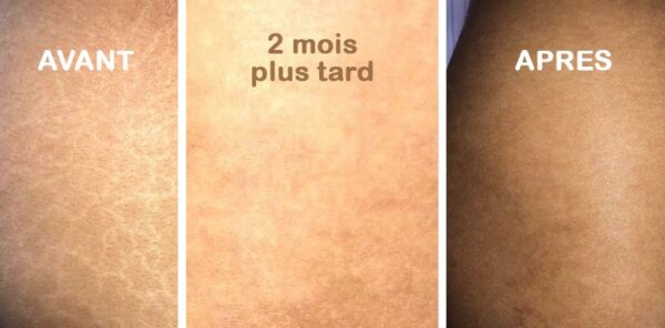 Traitement des vergetures - Dermocharme Genève, Suisse